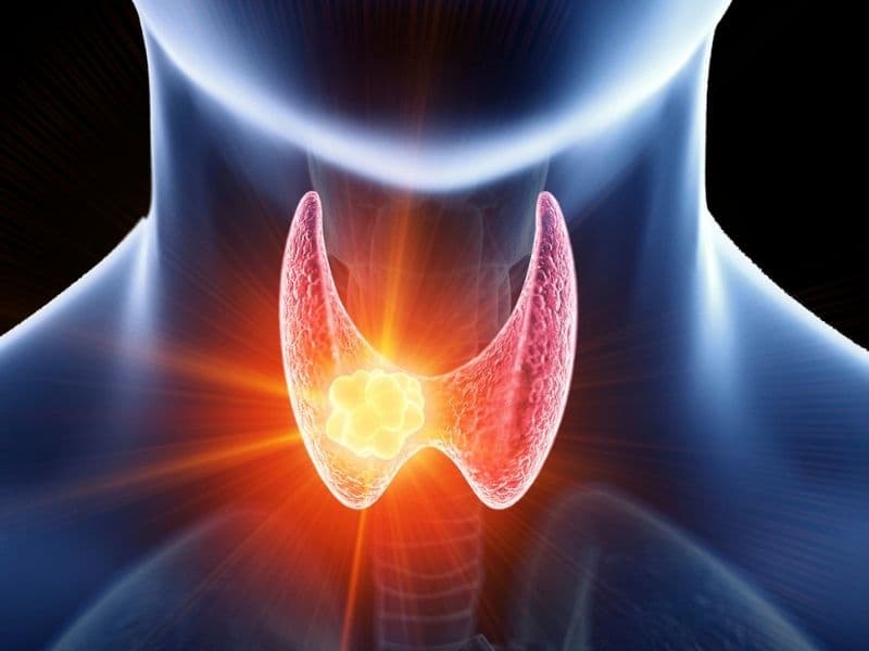 Paratiroid Adenomu Tedavisi - Antalya Genel Cerrahi Uzmanı